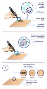 FreezPen Cryotherapy - Brooklin Laser Hair Removal Clinic & Spa